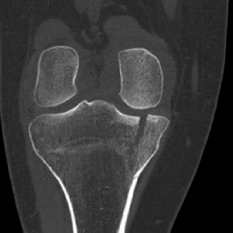 Knee Fractures