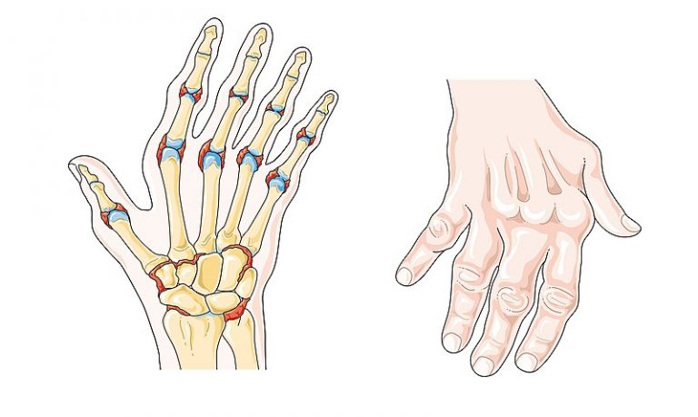 Hand Arthritis