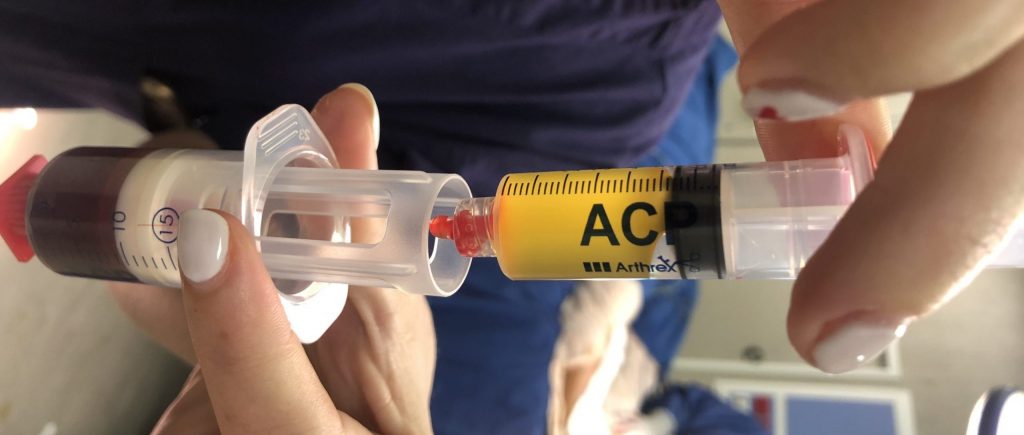 PRP (Platelet-Rich Plasma) Treatment | Joint Clinic Paarl