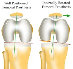 Patellofemoral Alignment Problems | Joint Clinic Paarl