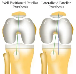 Patellofemoral Alignment Problems | Joint Clinic Paarl